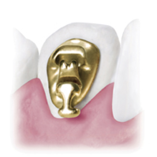 Invisible Incognito Lingual Braces | Solas Orthodontics